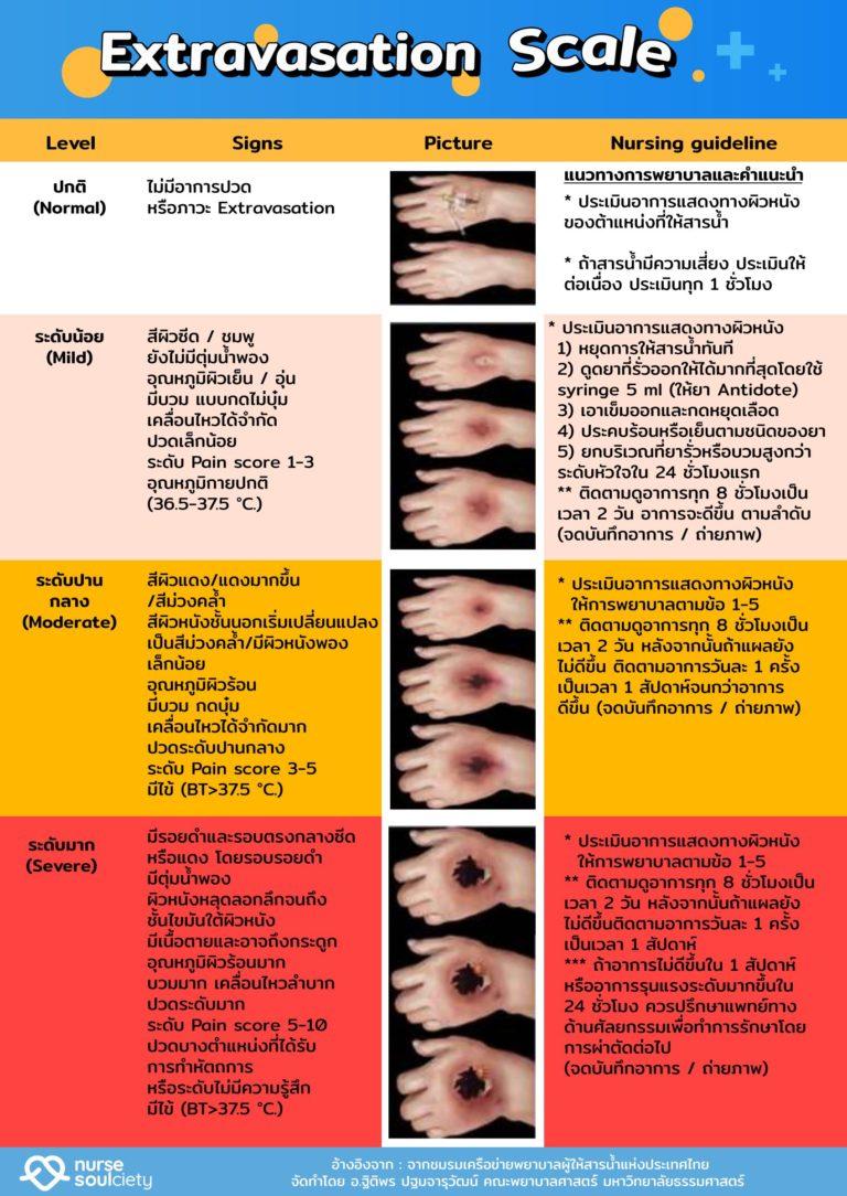 ภาวะรั่วซึมของสารน้ำหรือยาออกนอกหลอดเลือดดำ
